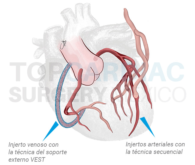Jorge Rossier de la Rosa - Top Cardiac Surgery Mexico